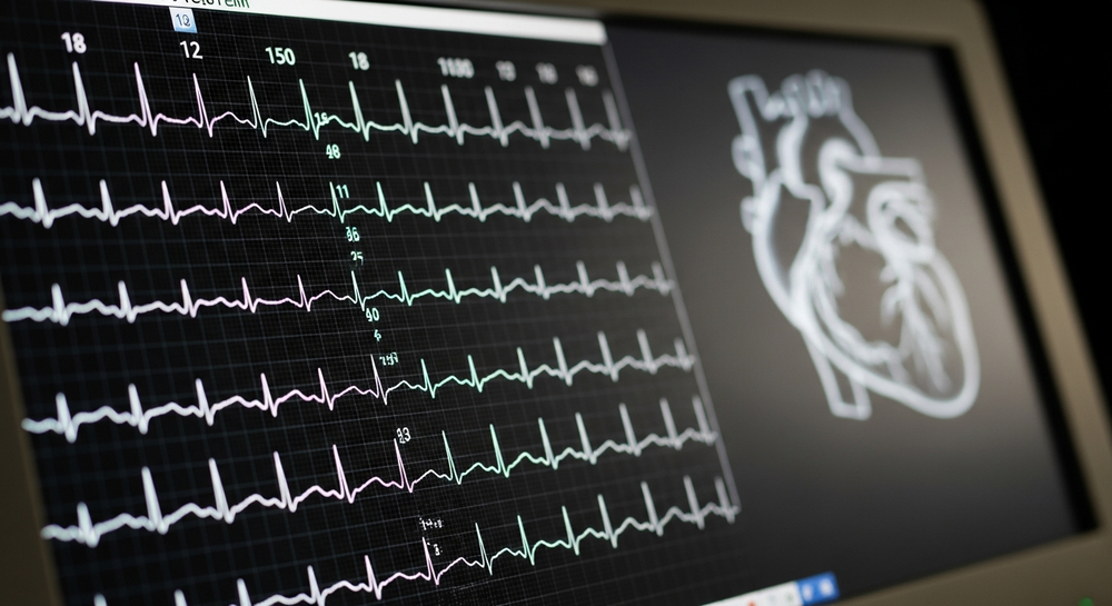 Infarct Silențios: De ce un EKG 18 Canale și Diagnostic Cardiac AI Sunt ...